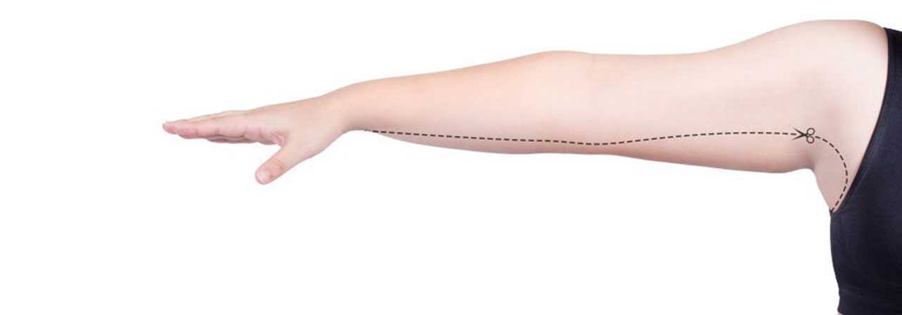 Arm lift surgery | Tagmeel Clinic | Plastic surgery